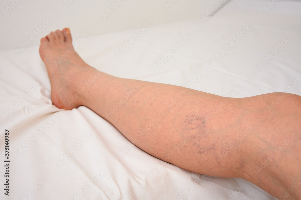 Varicose veins in female legs. The leg lies on a white sheet. Spider ...