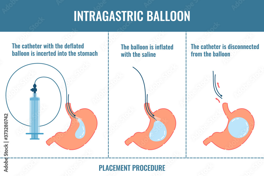 Intragastric balloon medical infographics. Medical procedure phases ...