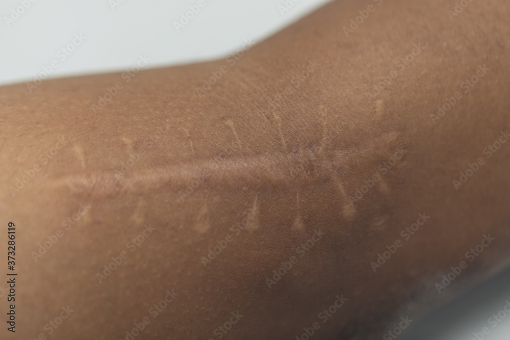 A scar is an area of fibrous tissue that replaces normal skin after an ...