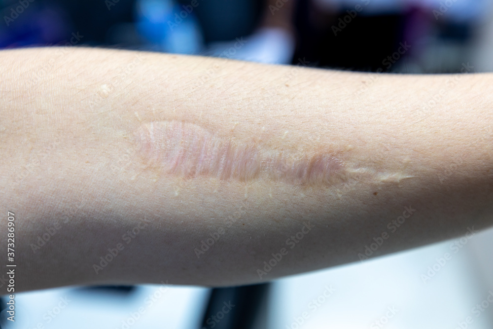 A scar is an area of fibrous tissue that replaces normal skin after an ...