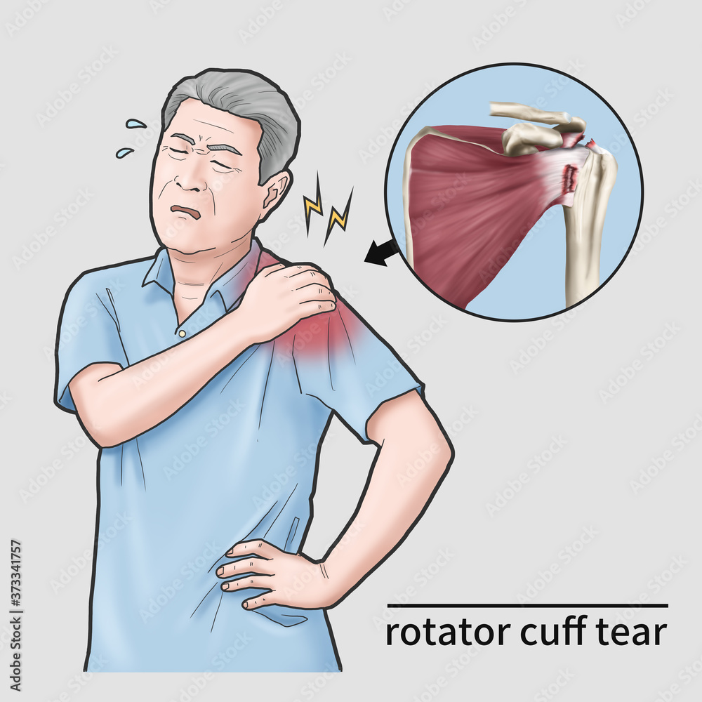 Shoulder pain man with rotator cuff tear Stock Illustration | Adobe Stock