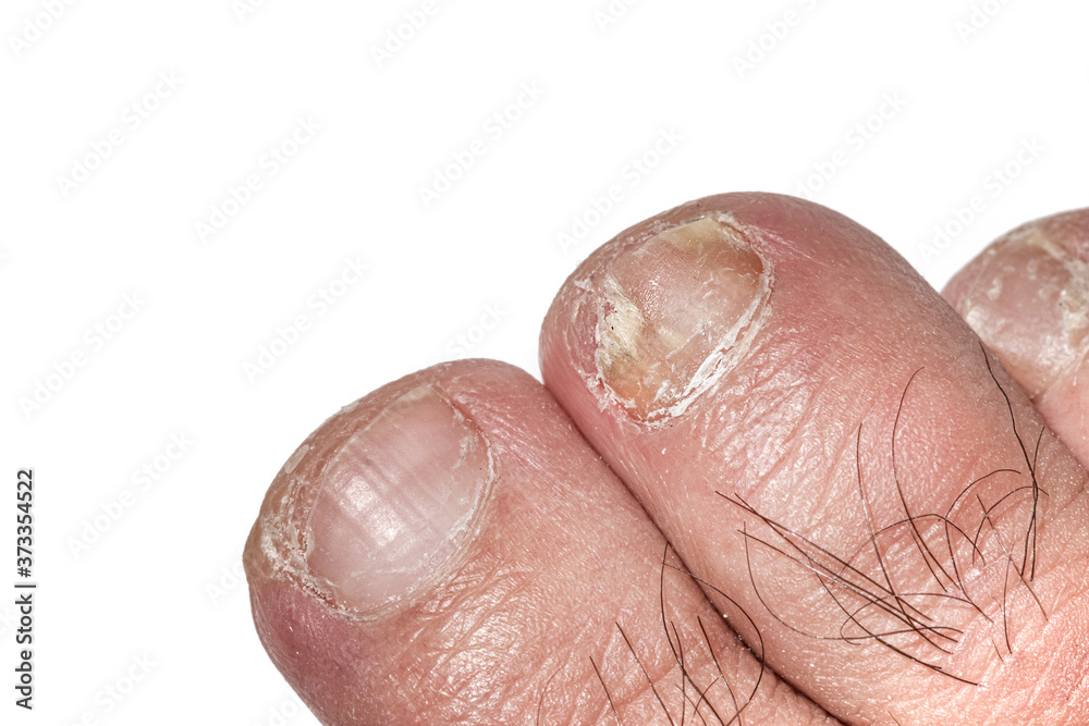 Macro photography of toe nails infected with Onychomycosis, a fungal ...