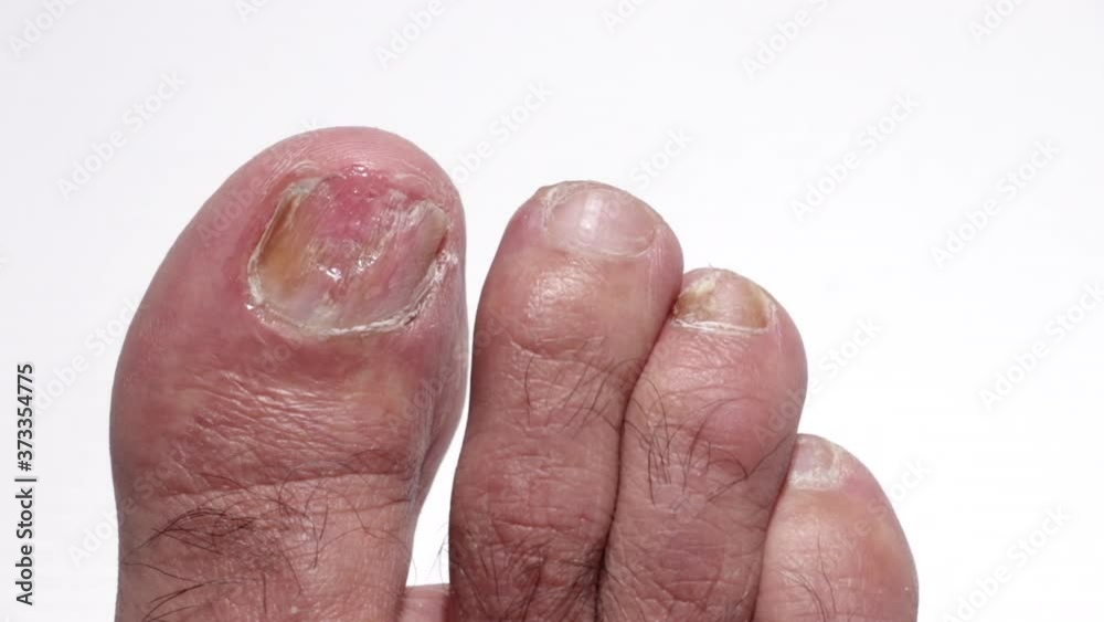 Panning of a big toenail with Onychomycosis, a fungal infection causing ...