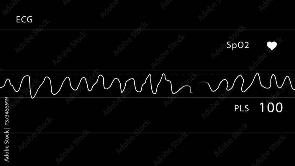 PNG Alpha.SpO2 HUD.ECG looping.Vfib.Heart rate Ventricular fibrillation ...