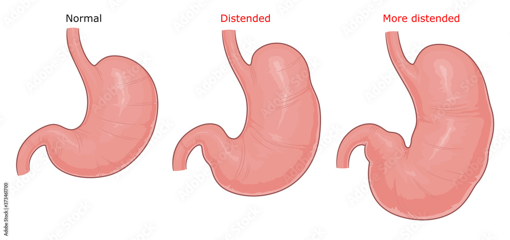 Distended stomach. Stretching of the stomach from overeating. Stages of ...