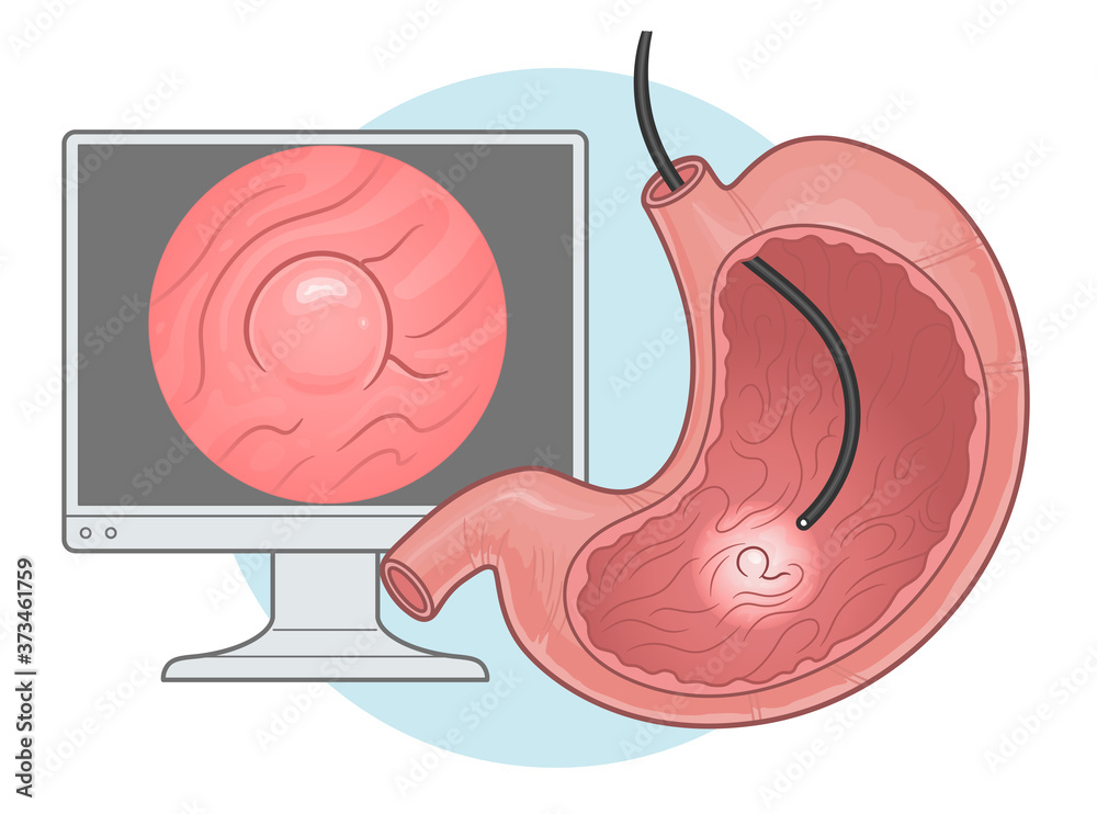 Gastroscopy procedure illustration. Diagnostics of gastric disease ...