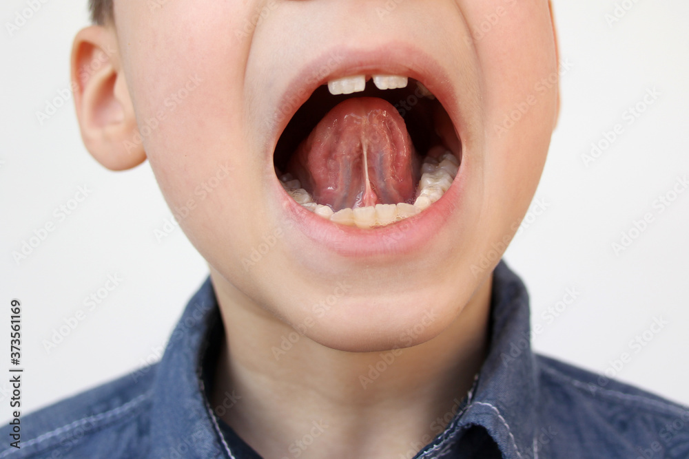 boy, kid opened his mouth, oral cavity, close-up teeth, performs ...