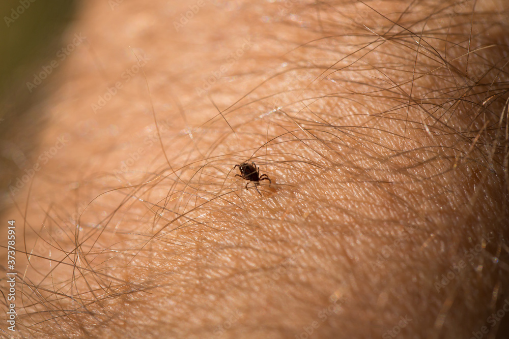 Tick Acari mite on human skin. Dangerous insects. Stock Photo | Adobe Stock