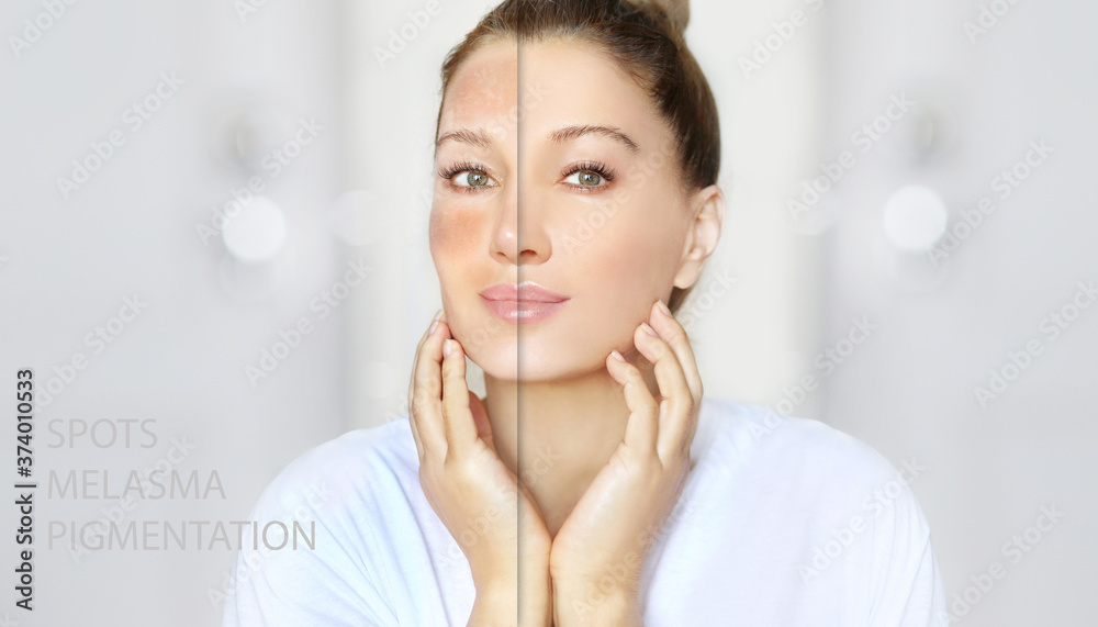 Foto de Dark spots, freckles,hyperpigmentation(melasma or chloasma ...