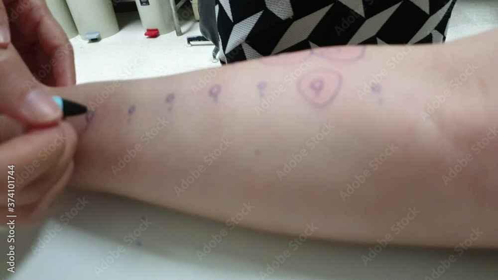 Process of food allergy skin prick test with rash sensitive reaction ...