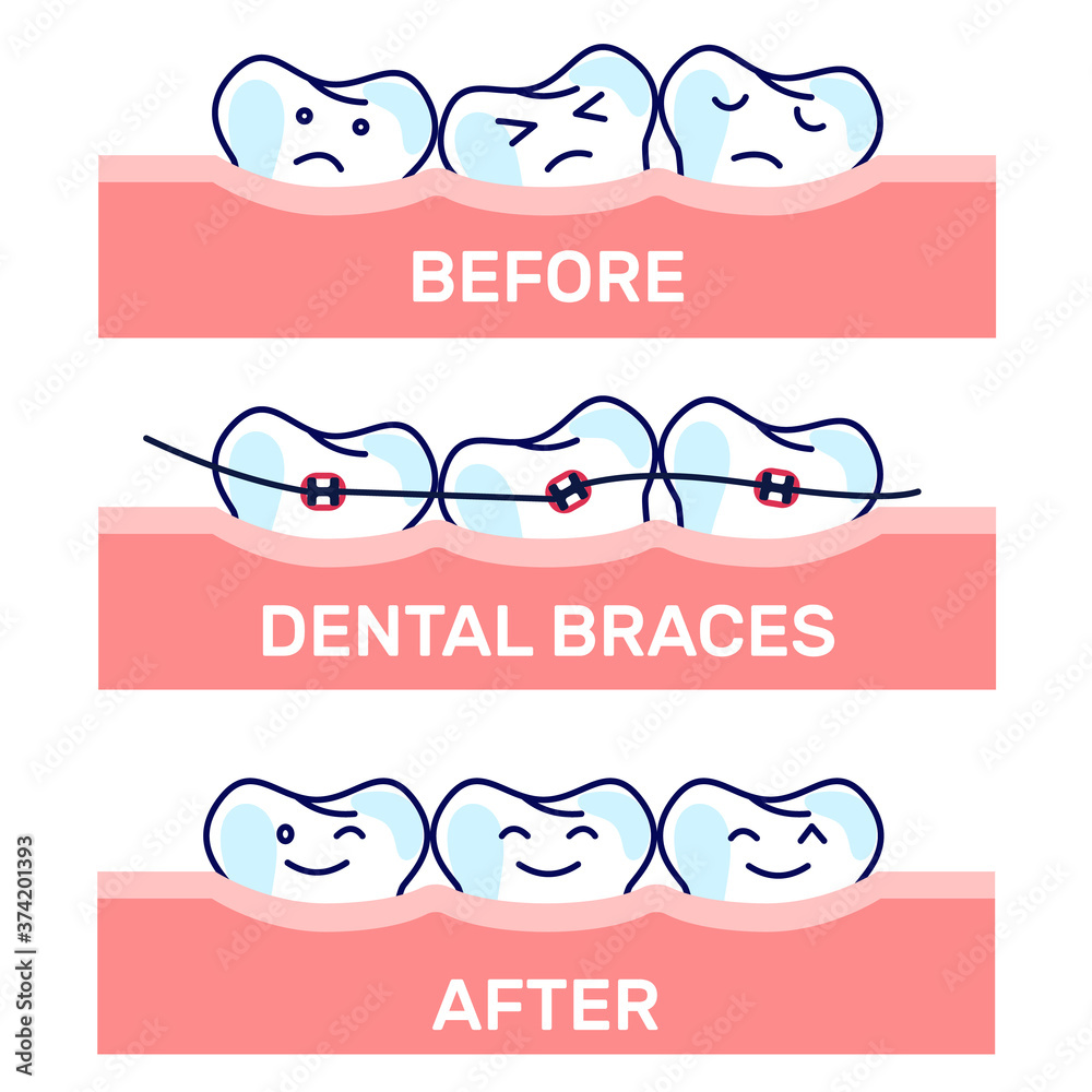 Cartoon kawaii funny teeth vector illustration, before and after brace ...