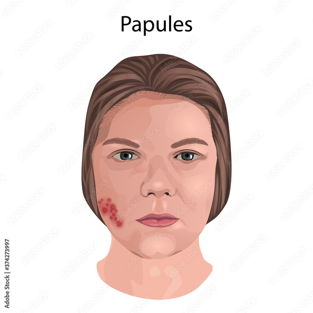 Acne. Papules. Young woman face with skin inflammation. Stock ...