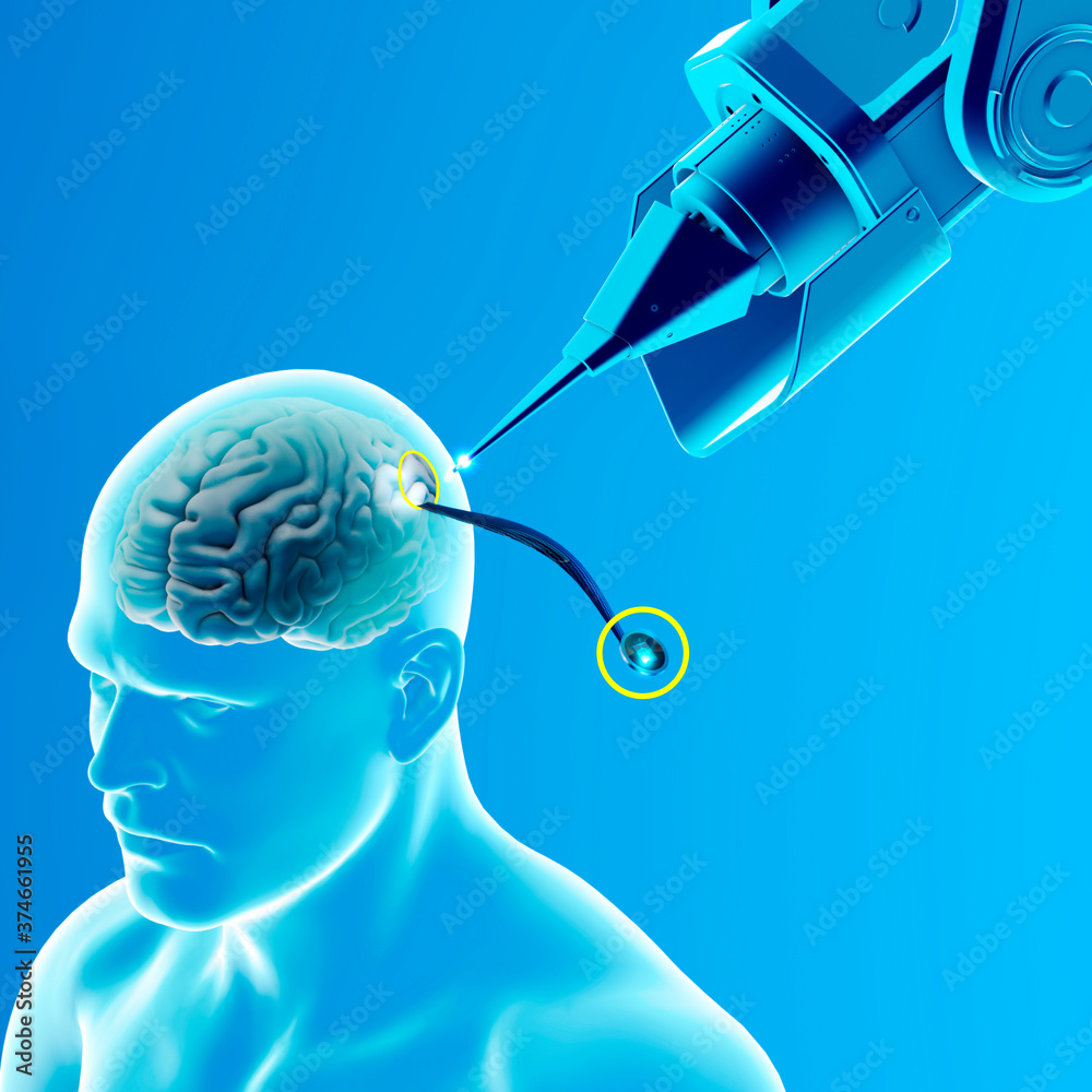 Link, neuralink, new artificial intelligence technology that allows you ...