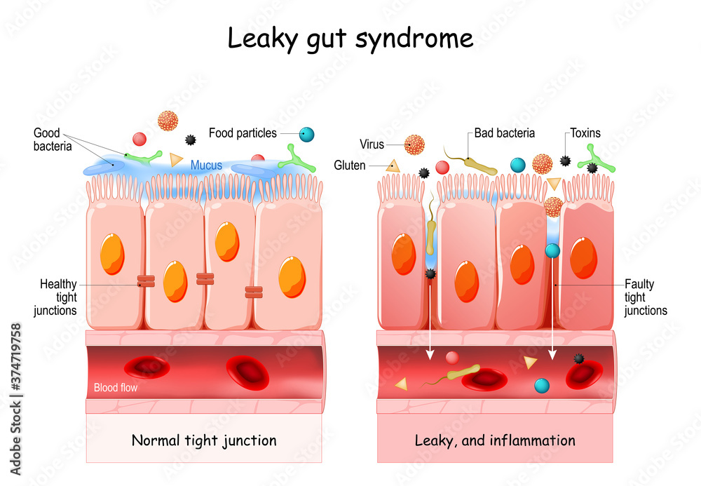 Leaky gut Syndrome Stock Vector | Adobe Stock