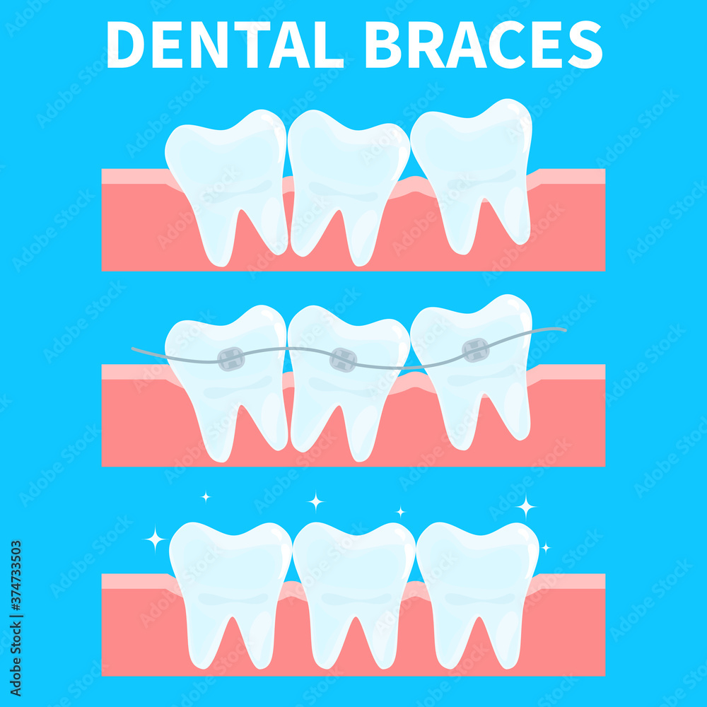 Cartoon teeth vector illustration, before and after brace correction ...