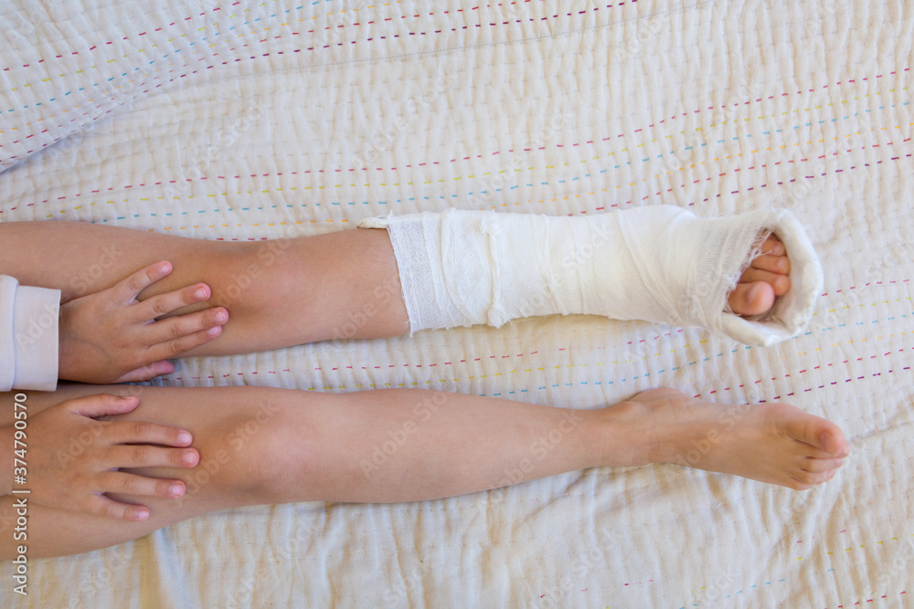 broken leg. Close-up of the cast on the feet. exercises to repair and ...