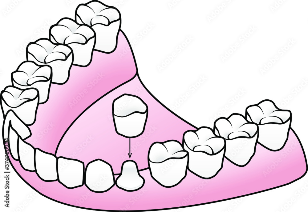 Diagram showing the process of fitting a prosthetic dental crown / cap ...