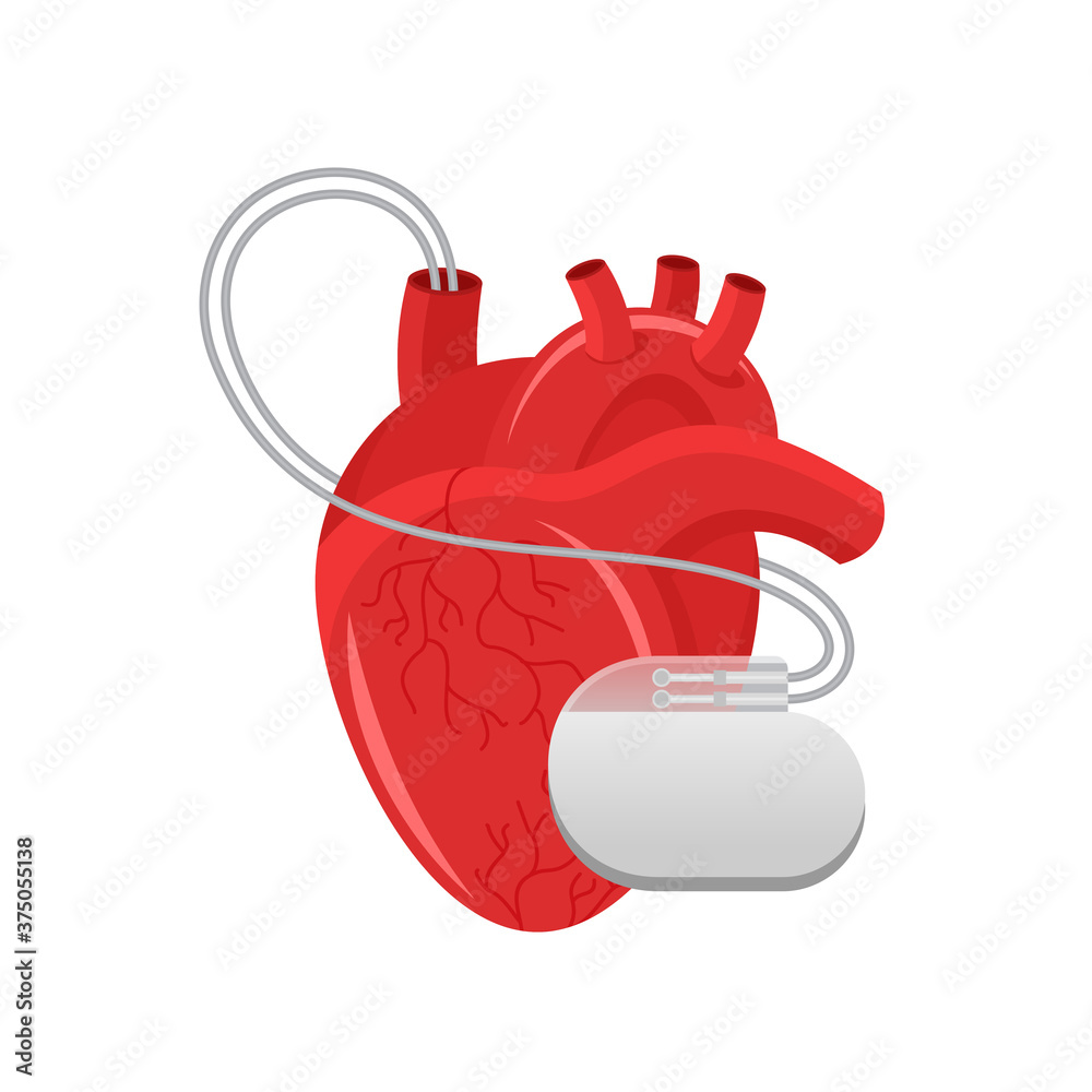 Pacemaker illustration - human heart and cardio implant - vector ...