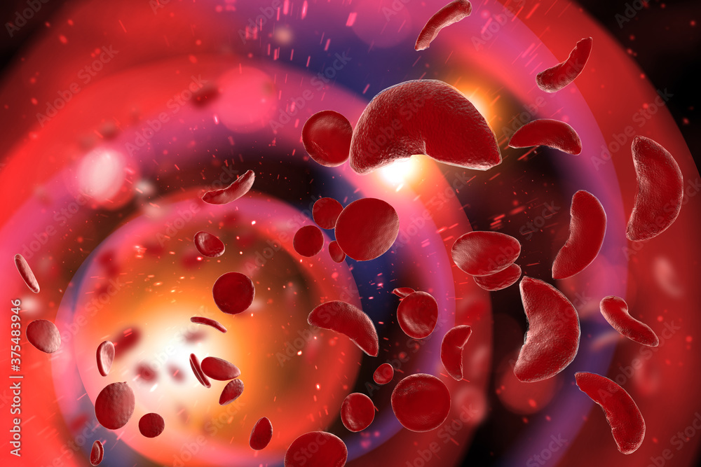 Sickle Cell Anemia 3D Illustration Stock Illustration | Adobe Stock