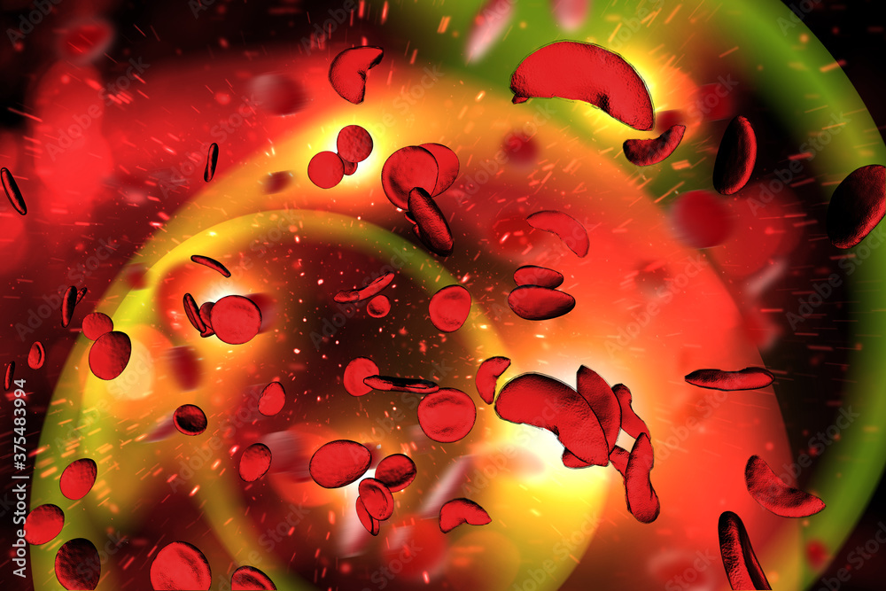Sickle Cell Anemia 3D Illustration Stock Illustration | Adobe Stock