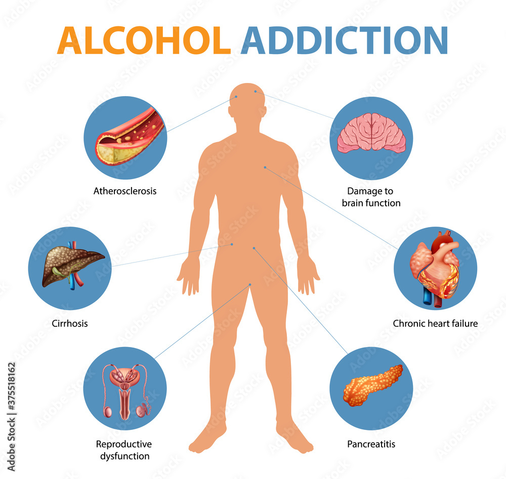 Addison's disease symptoms infographic Stock Vector | Adobe Stock