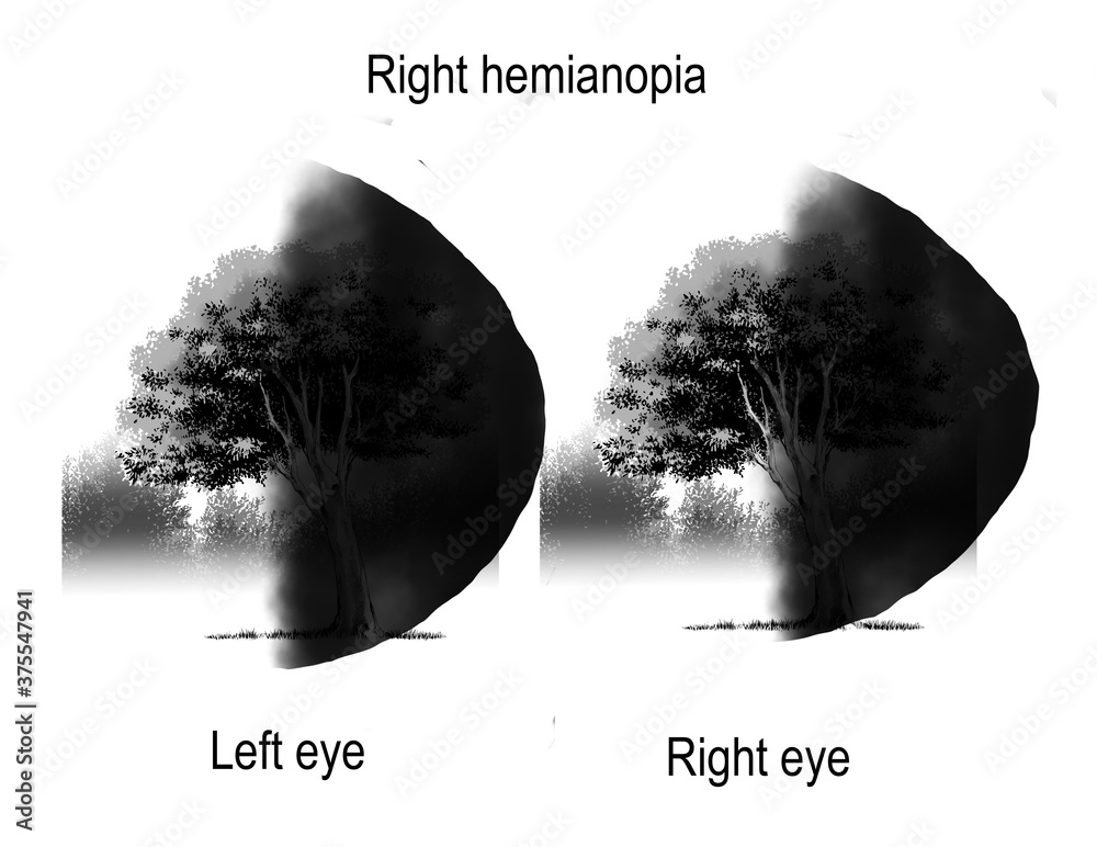 patterns of visual field defects are sign and symtomp of loss of vision ...