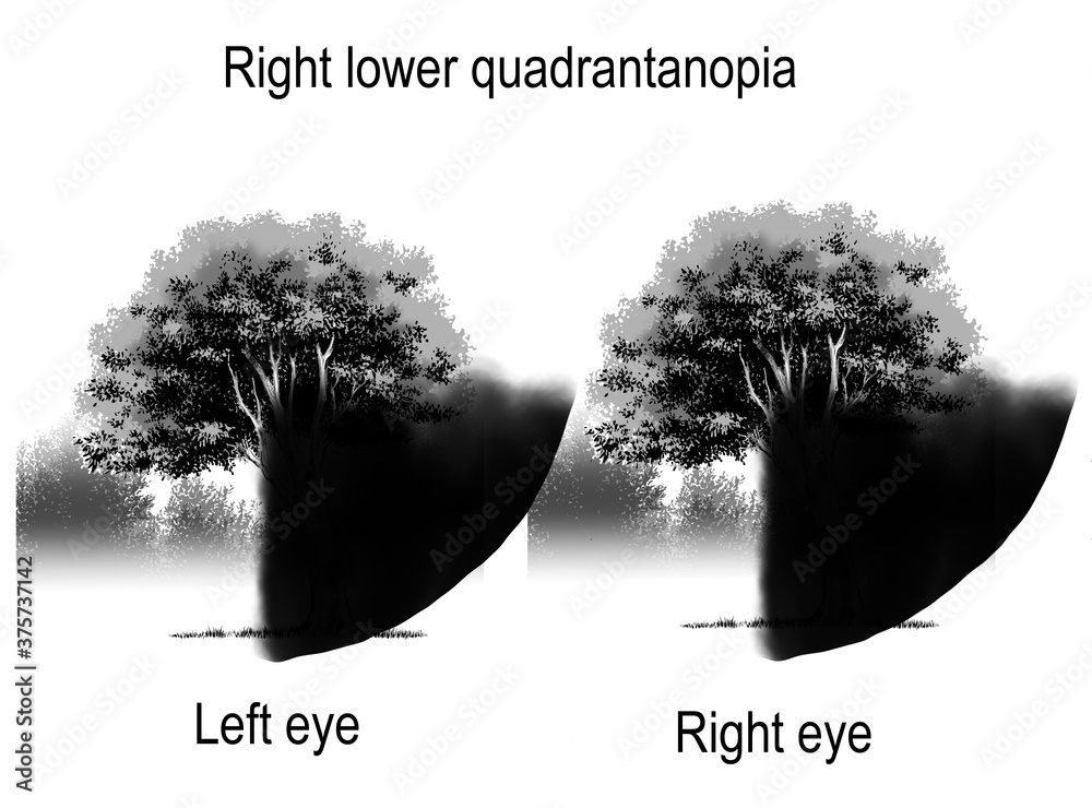 right lower qaudrantanopia is the sign and symptom of visual field ...