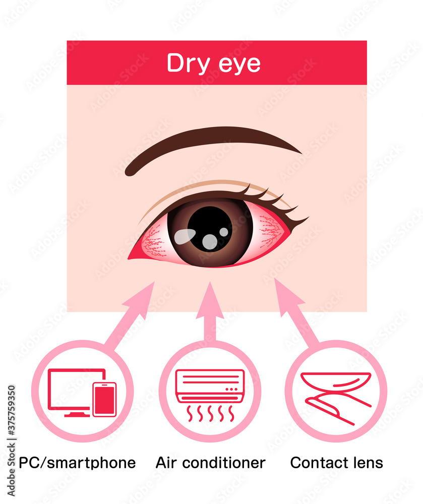 Causes of dry eye vector illustration Stock Vector | Adobe Stock