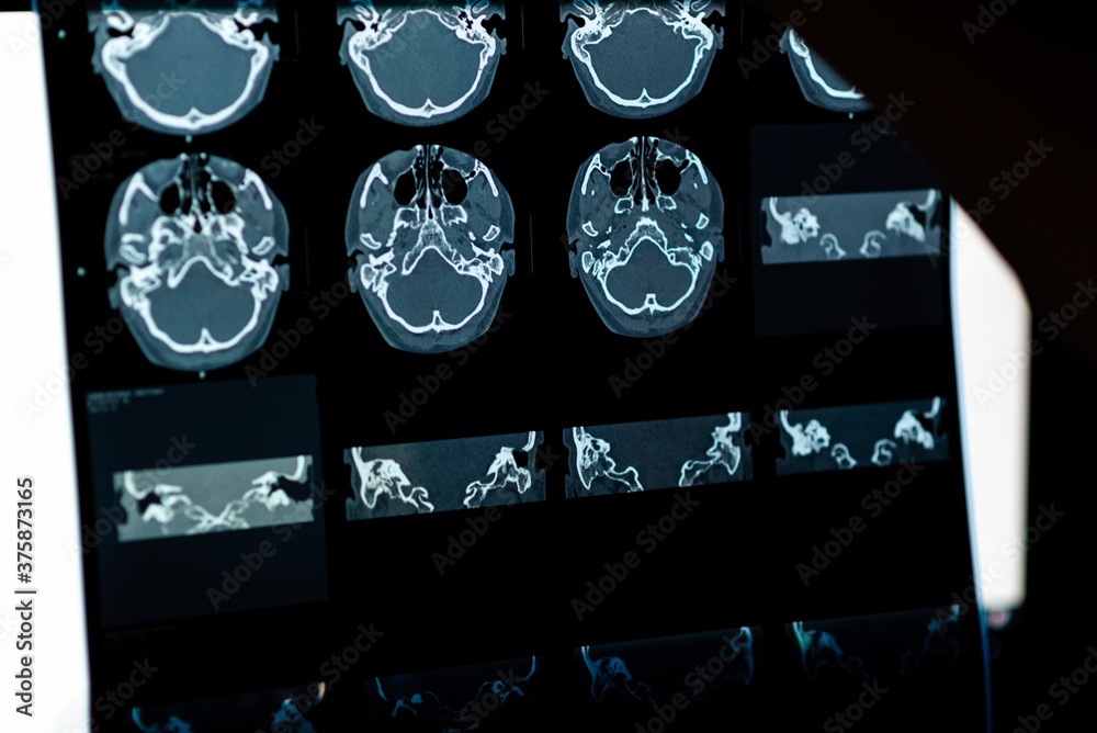 Brain CT scan x-ray film image Brain Stock Photo | Adobe Stock