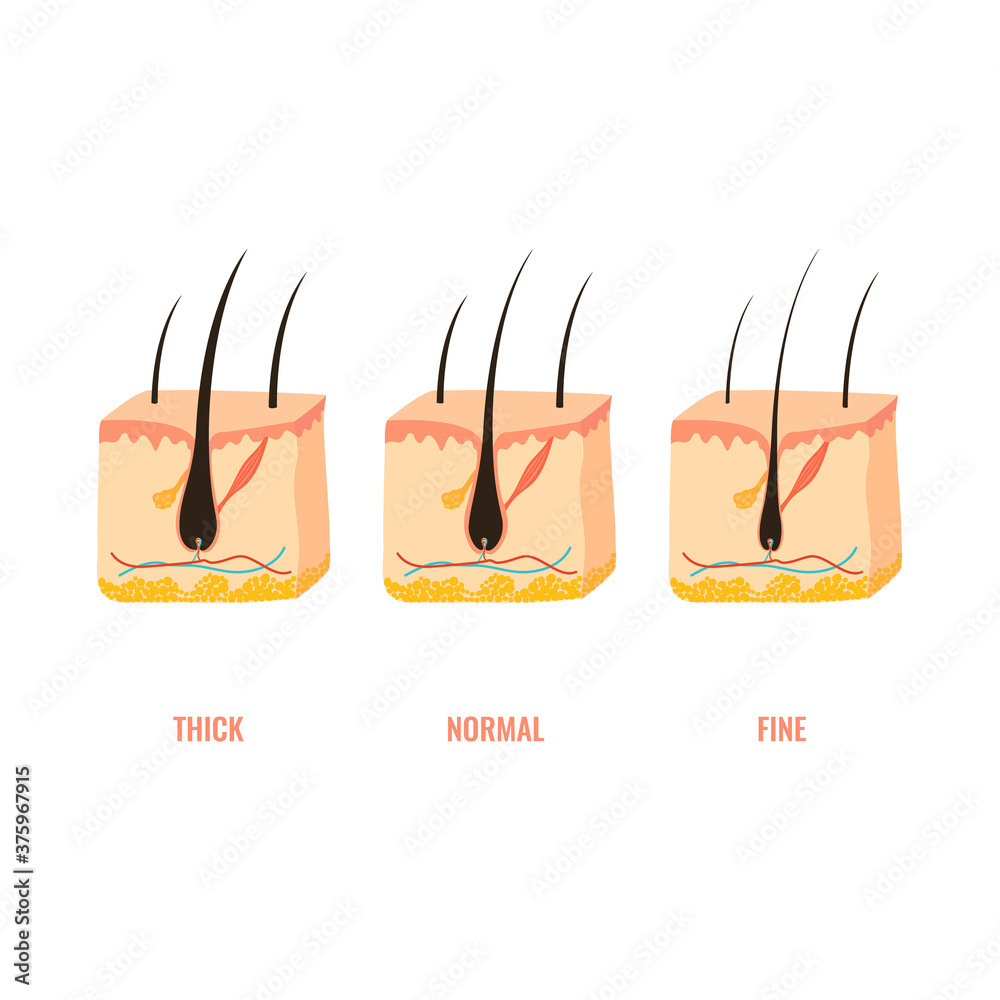 Hair thickness types classification set. Skin cross-section with fine ...