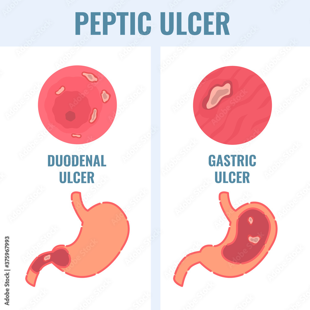 Peptic ulcer stomach disease infographic poster. Endoscopic image of ...