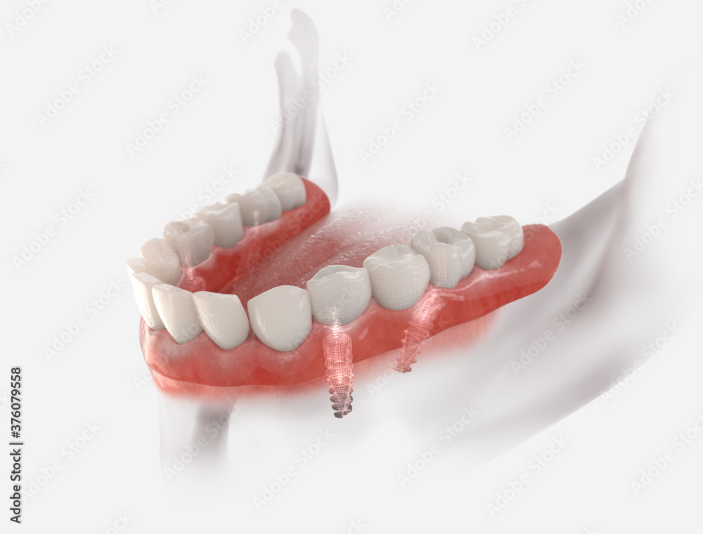 Mandibular fixed restoration with 4 implants, posterior are tilted. 3d ...