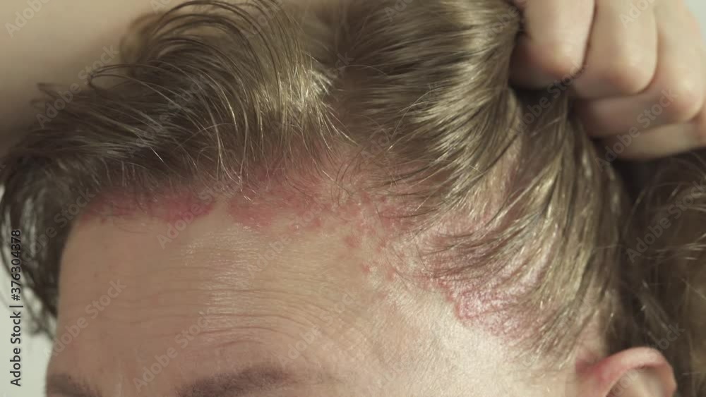 Braiding Hair Allergic Reaction at Milla Gadsdon blog