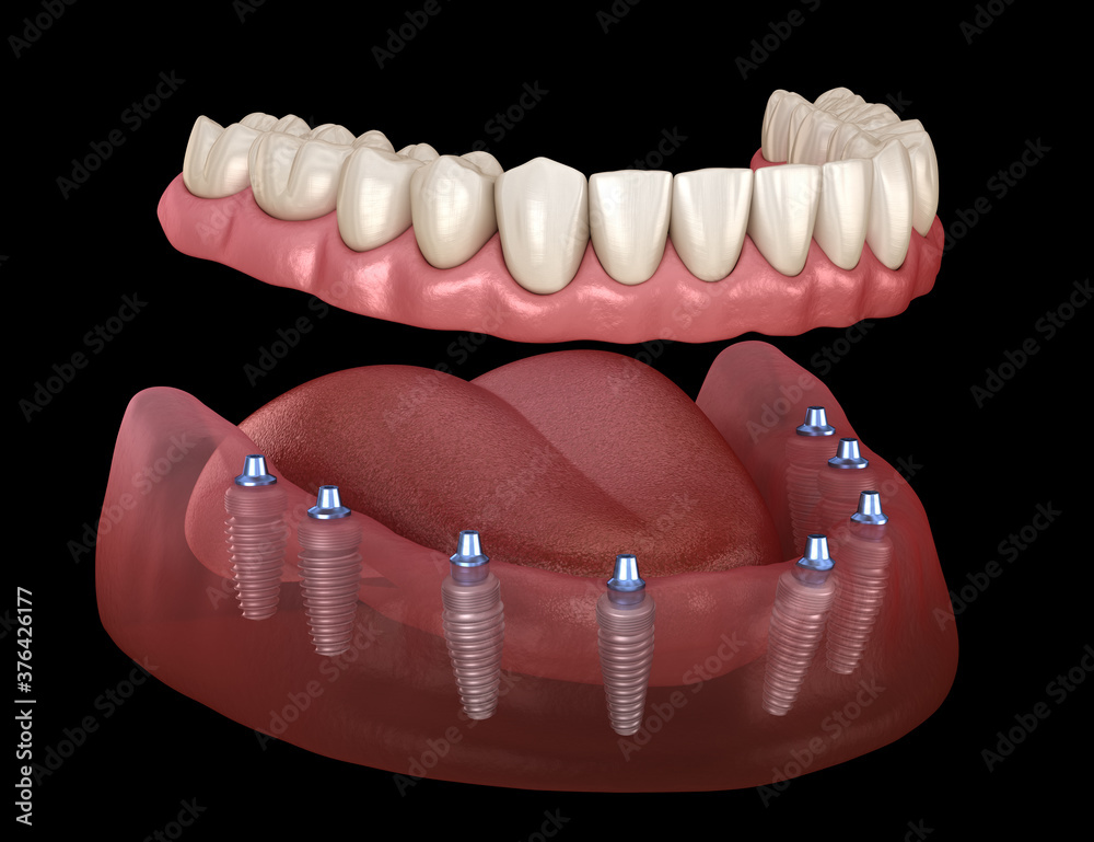 Mandibular prosthesis All on 8 system supported by implants. Medically ...
