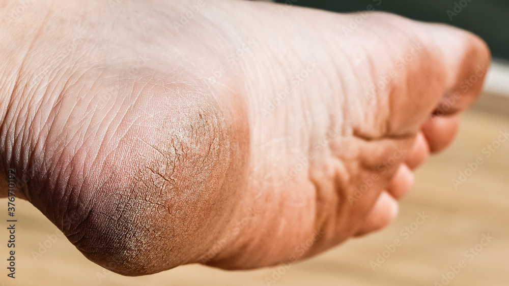 Man cracked heel. Dirt feet, cracked feet due to walking barefoot ...