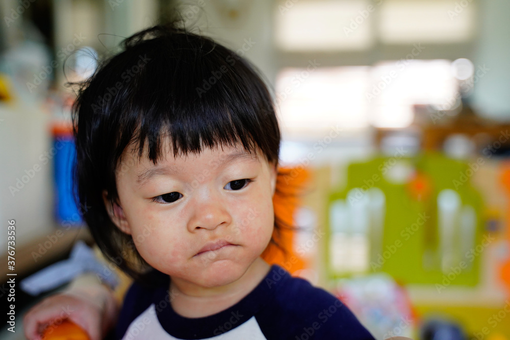 Pityriasis rosea appear scaly spot on baby face,Asian baby is sad,she ...