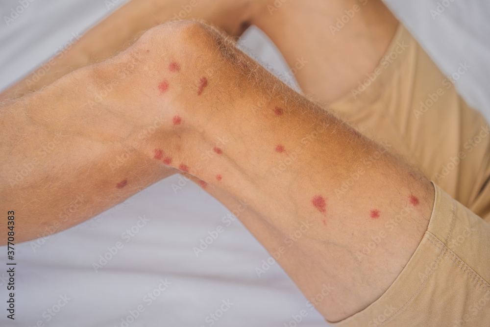 Legs with many red spot and scar from insect bites. Mosquitos allergy ...