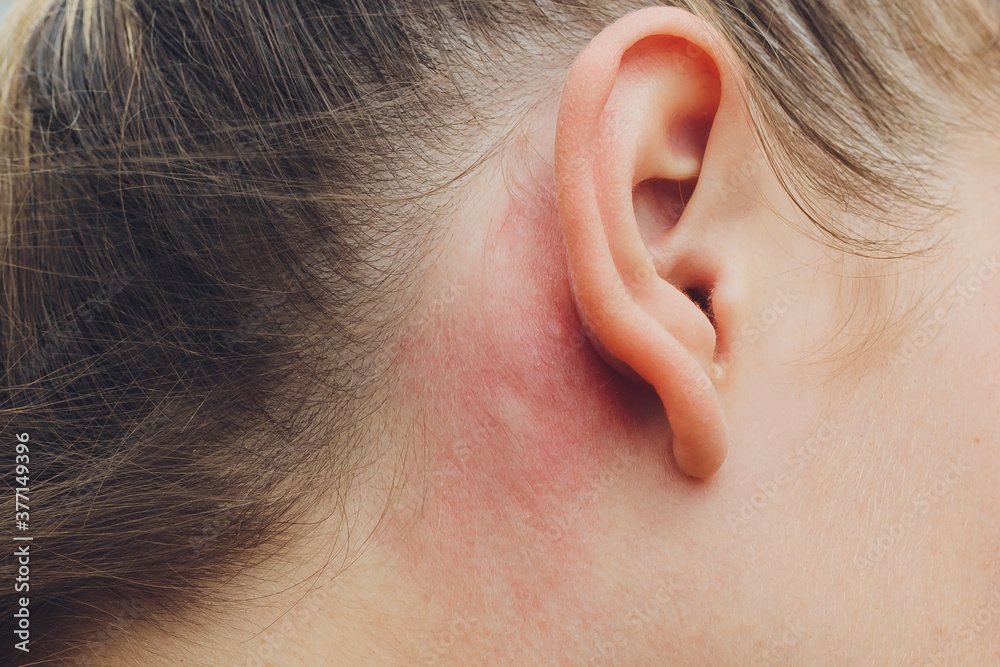 Poster Allergic skin reaction on the man behind the ear caused by ...