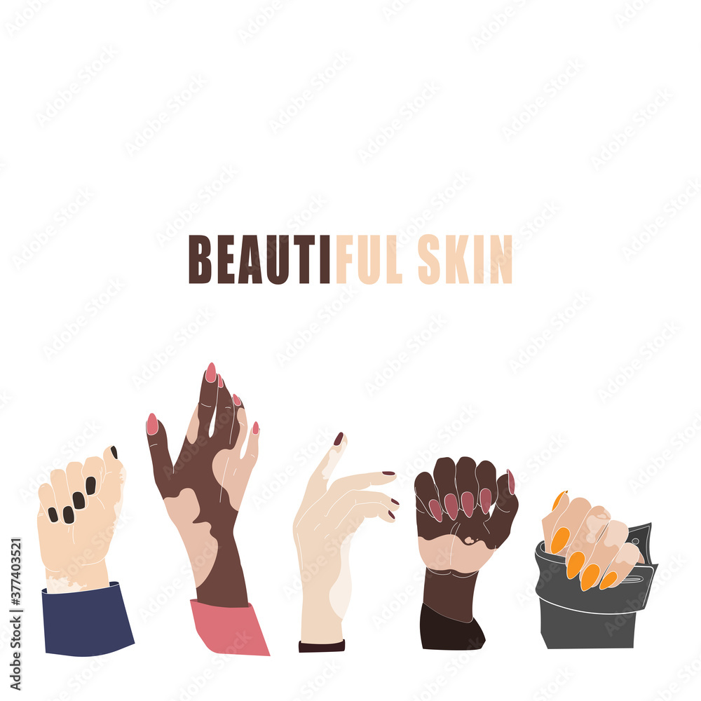 Hands with age spots or vitiligo isolated vector. Hand gestures with ...