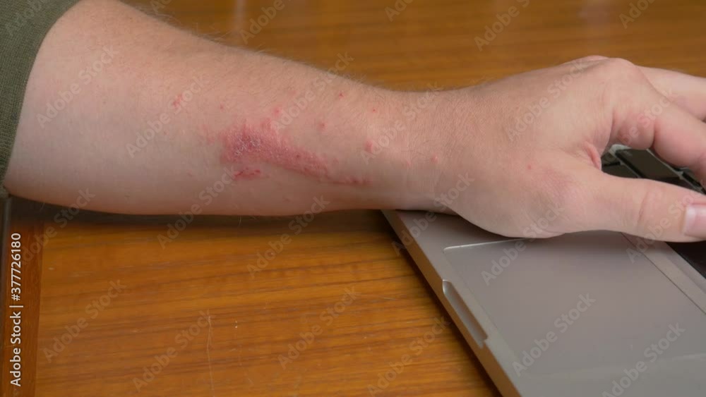 Hiding skin rash or breakout concept. Man with a skin rash breakout ...