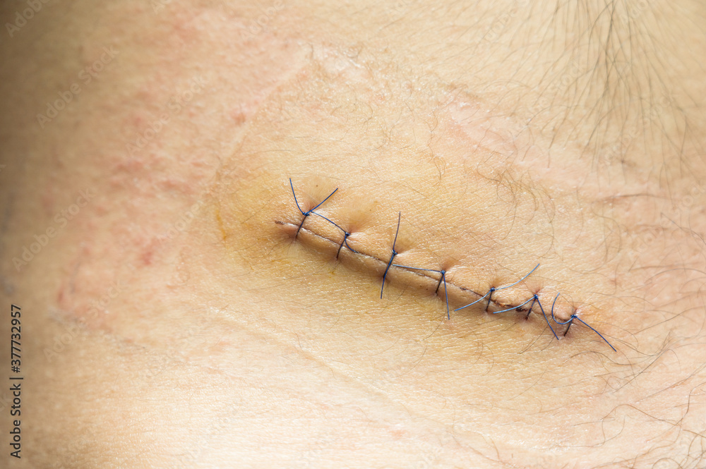 Nurse or Doctor hand treating the wound patient to clean the wound ...