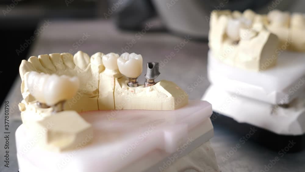 Dental prosthesis, artificial tooth, prosthetic. Male hands setting ...