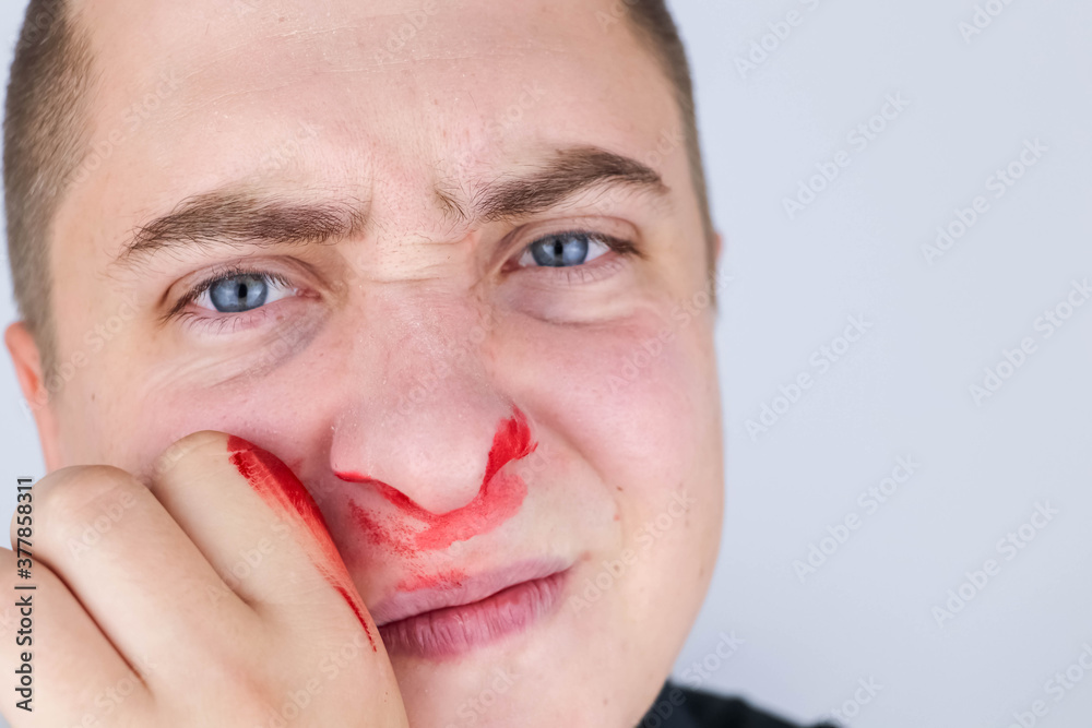 Stockfoto med beskrivningen The man has a broken nose after a fight ...