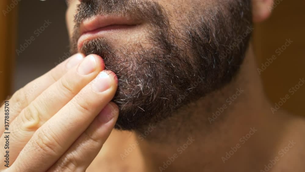 Detail of the man's chin with seborrheic dermatitis in the beard area ...