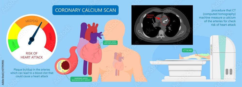 Cardiac Calcium Scoring chest health signs X-ray block treat blood ...