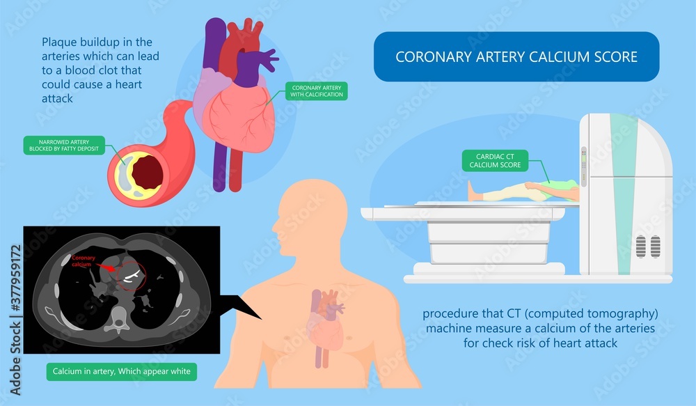 Cardiac Calcium Scoring chest health signs X-ray block treat blood ...