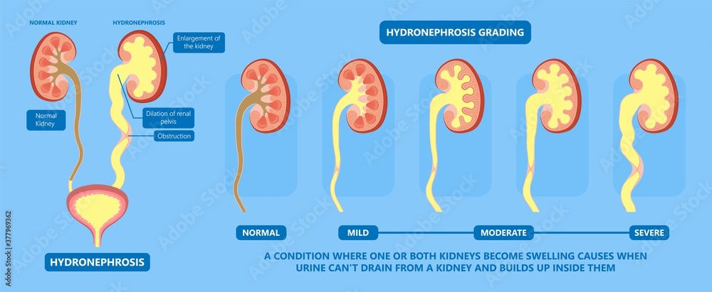 kidney damage UTI scan test tube VCUG acute VUR cyst exam flow pain ...