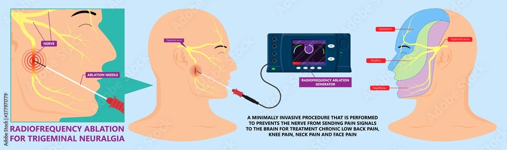RFA low arm leg hip pain back neck knee pars bone nerve treat joint ...
