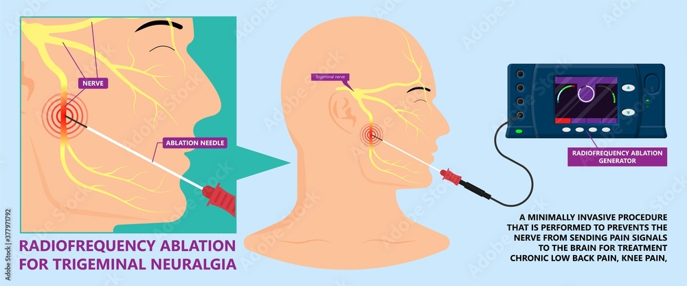 RFA low arm leg hip pain back neck knee pars bone nerve treat joint ...