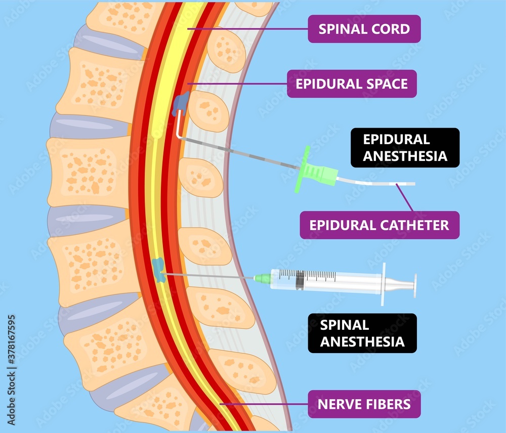 Epidural spinal block anaesthesia Pinched relieve General vaginal ...